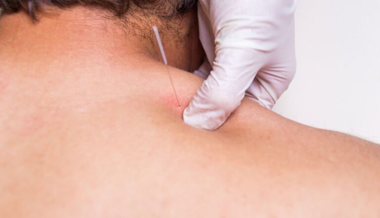 Benefits of Dry Needling for Athletes | Lycoming Orthopedics & Sports ...